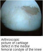 ADVANCE ORTHOPEDIC AND SPORTS INJURY HOSPITAL || Cartilage Injuries