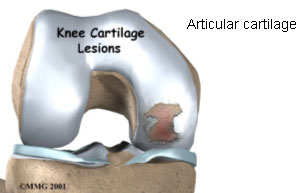 ADVANCE ORTHOPEDIC AND SPORTS INJURY HOSPITAL || Cartilage Injuries